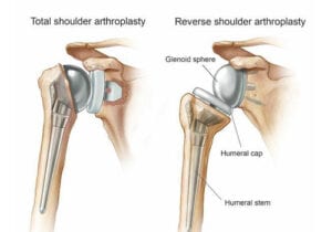 Degenerative Joint Disease-TSA/Reverse TSA - Kenneth Bramlett, MD