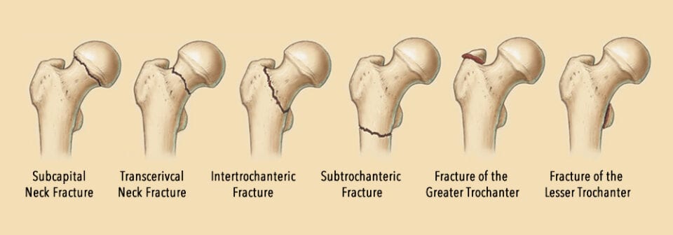 Hip Fracture - Kenneth Bramlett, MD