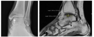 Osteochondritis Dissecans of the Talar Dome - Kenneth Bramlett, MD